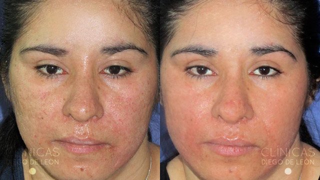 Eliminar Marcas de Acné - Clínicas Diego de León