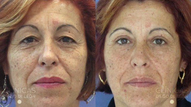 Blefaroplastia: Cirugía de Párpados | Clínicas Diego de León