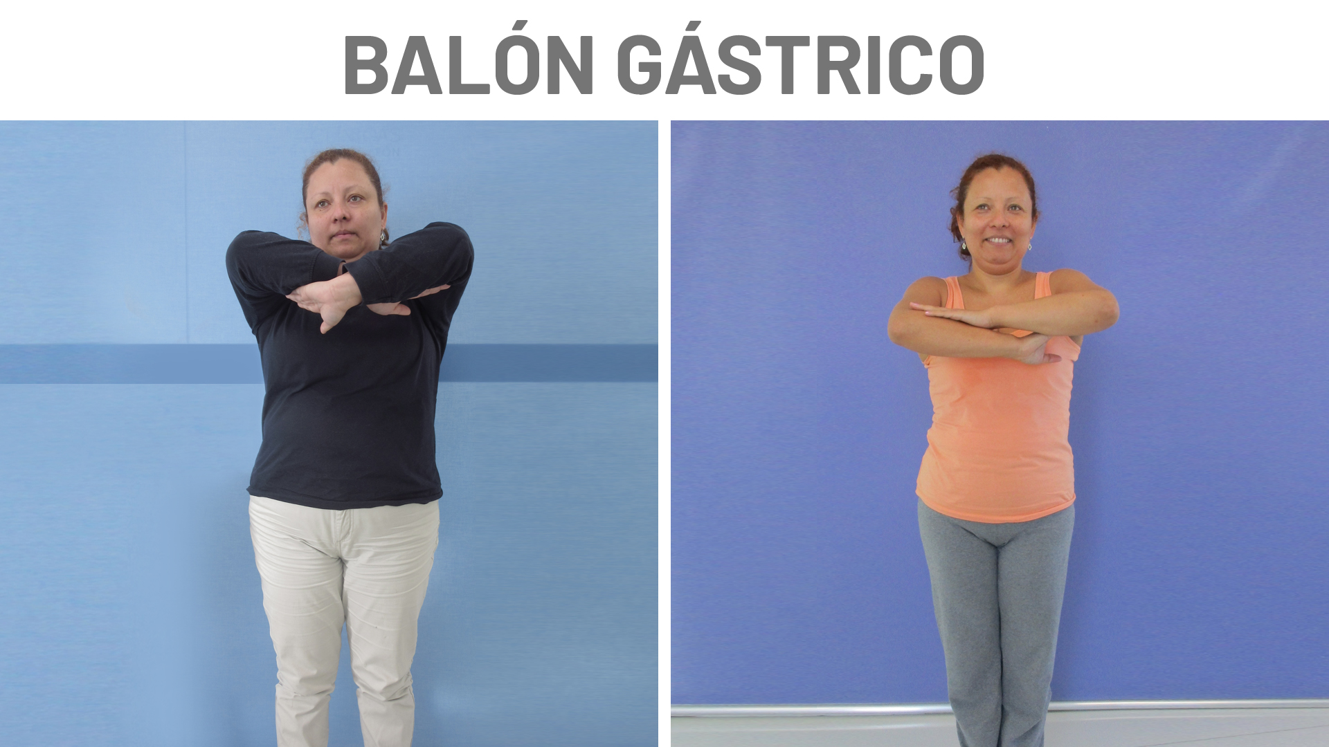 Balón Gástrico: Testimonio de Kery - Clínicas Diego de León