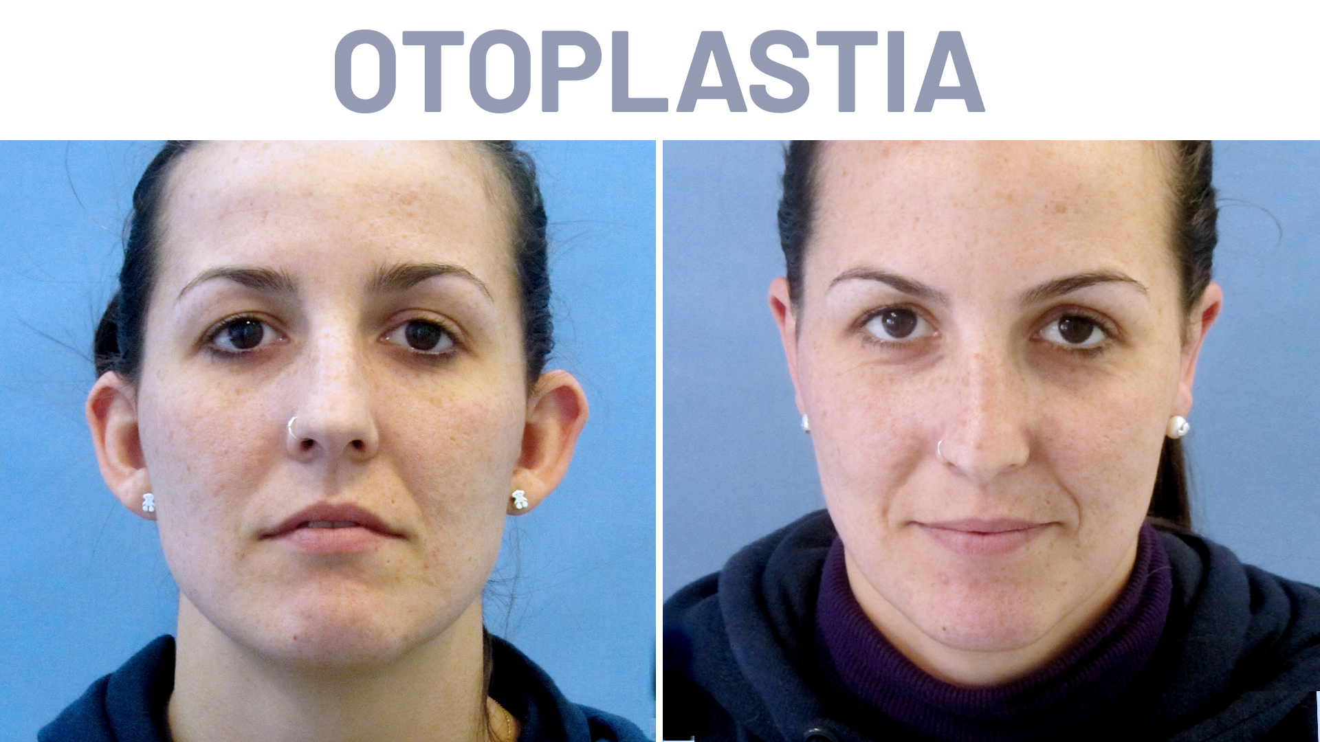 Operación de orejas antes y después - Clínicas Diego de León