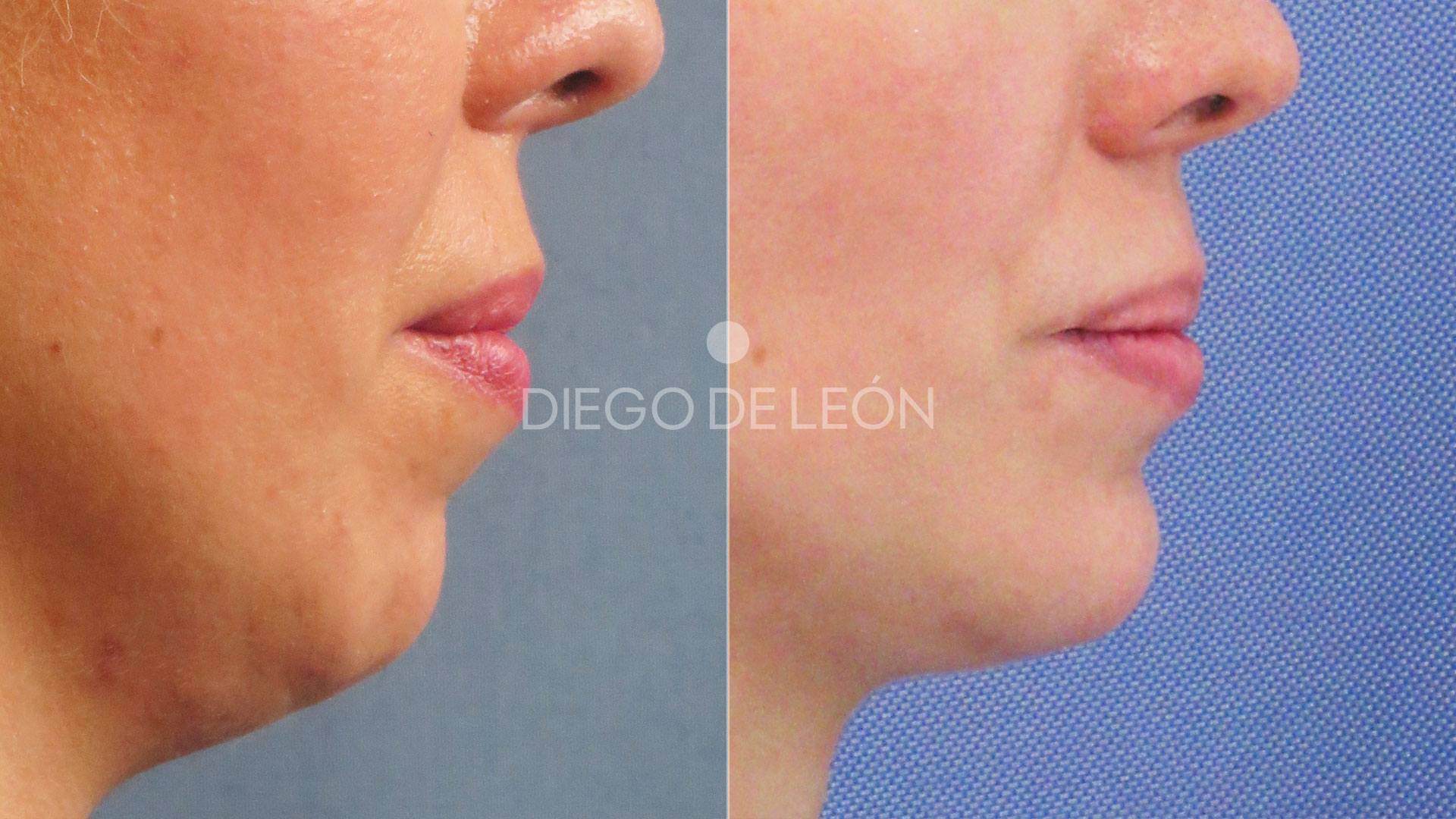 Resultados Cirugía del Mentón - Clínicas Diego de León