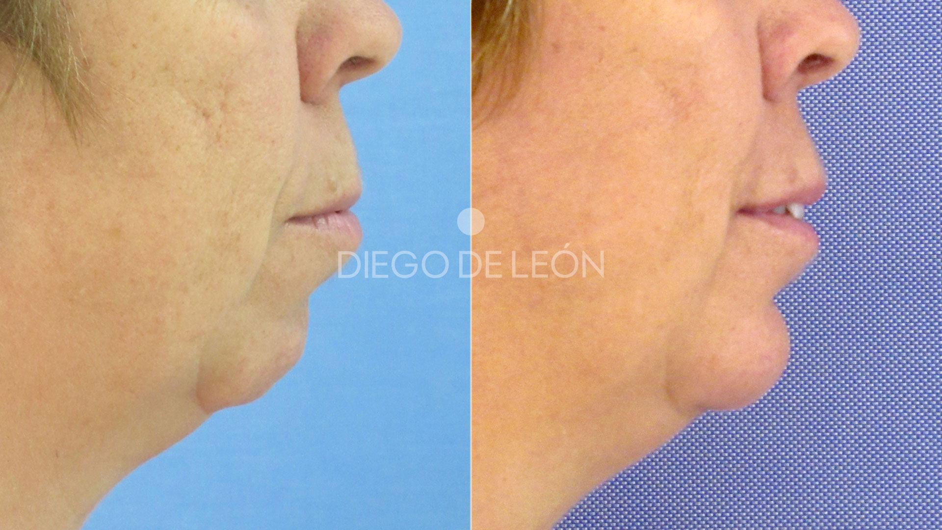Aumento de Mentón | Resultados - Clínicas Diego de León