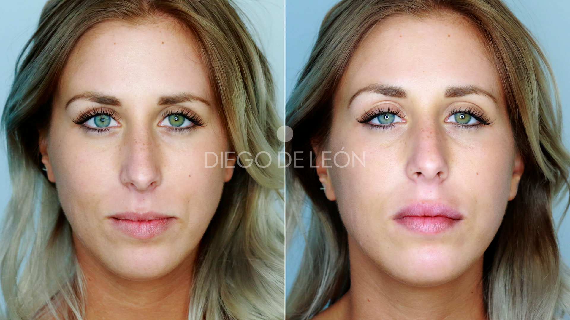 Resultado de un relleno de labios - Clínicas Diego de León