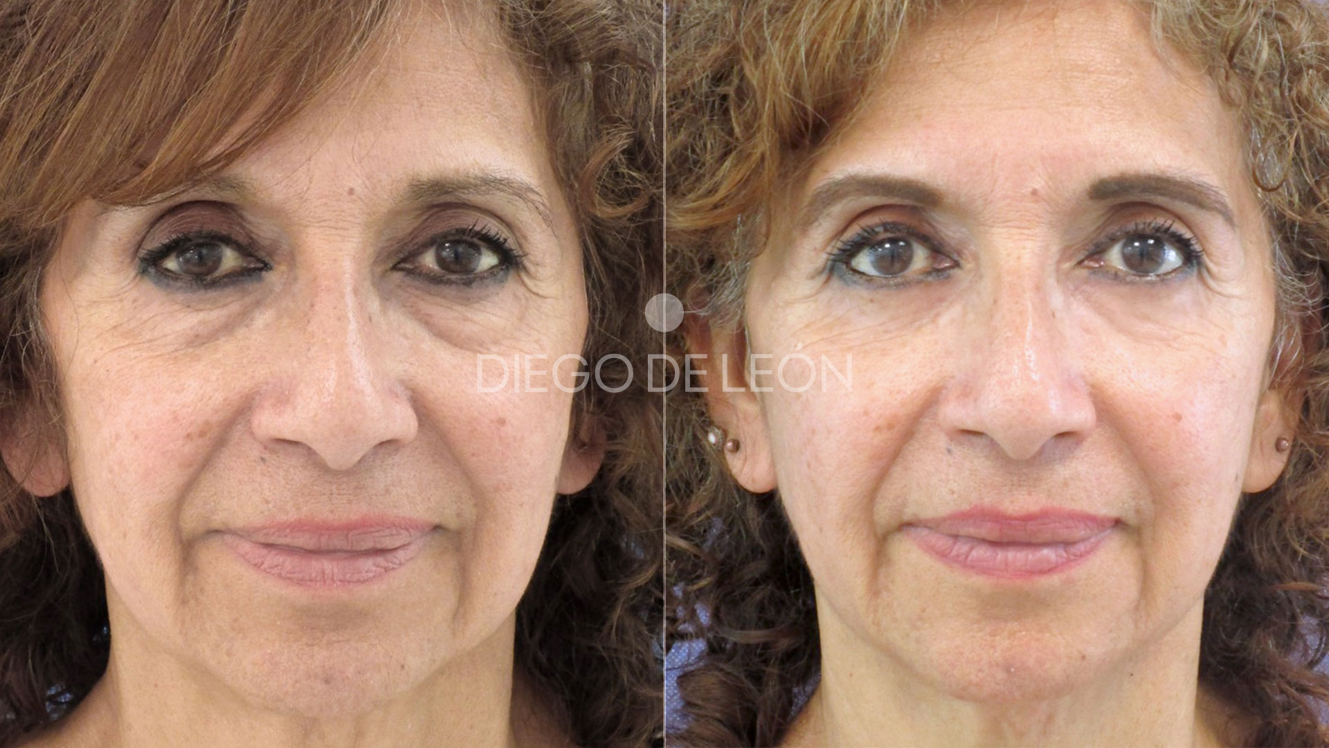 Estética de Ojos | Clínicas Diego de León