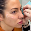 Endolifting | Clínicas Diego de León