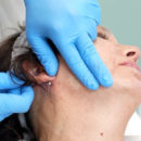 Endolifting | Clínicas Diego de León